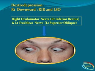 Extraocular Eye Movement Test