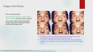 Ocular Myastenia gravis.pptx