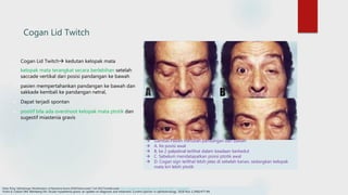 Ocular Myastenia gravis.pptx