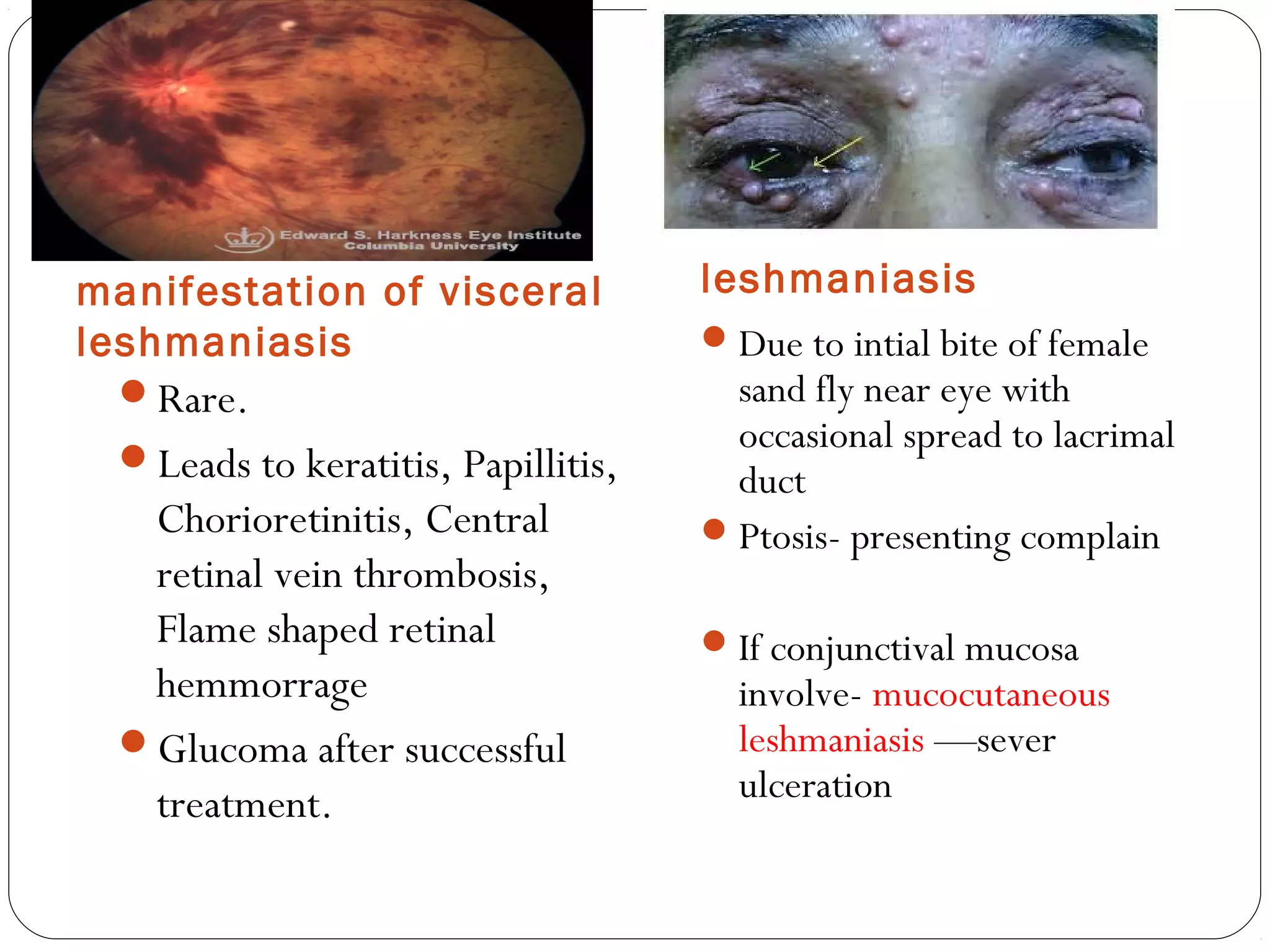 Ocular parasitic infection | PPT