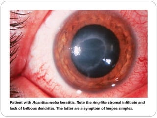 Ocular parasitic infection | PPT