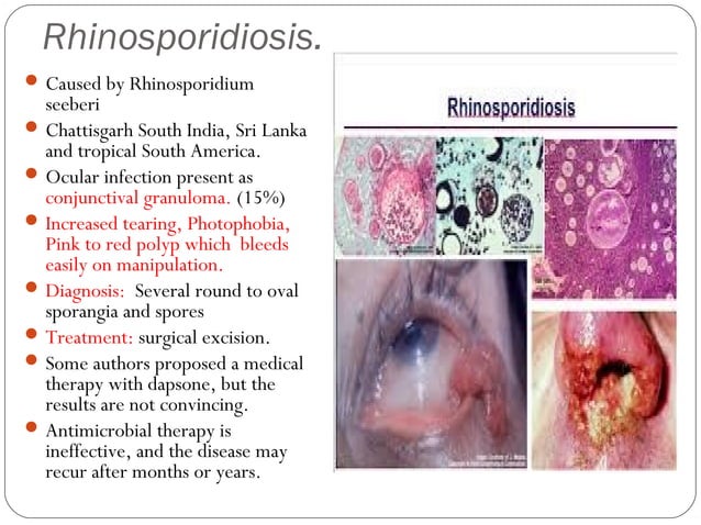 Ocular parasitic infection | PPT
