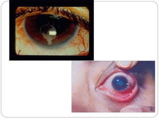 Ocular parasitic infection | PPT
