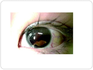 Ocular parasitic infection | PPT