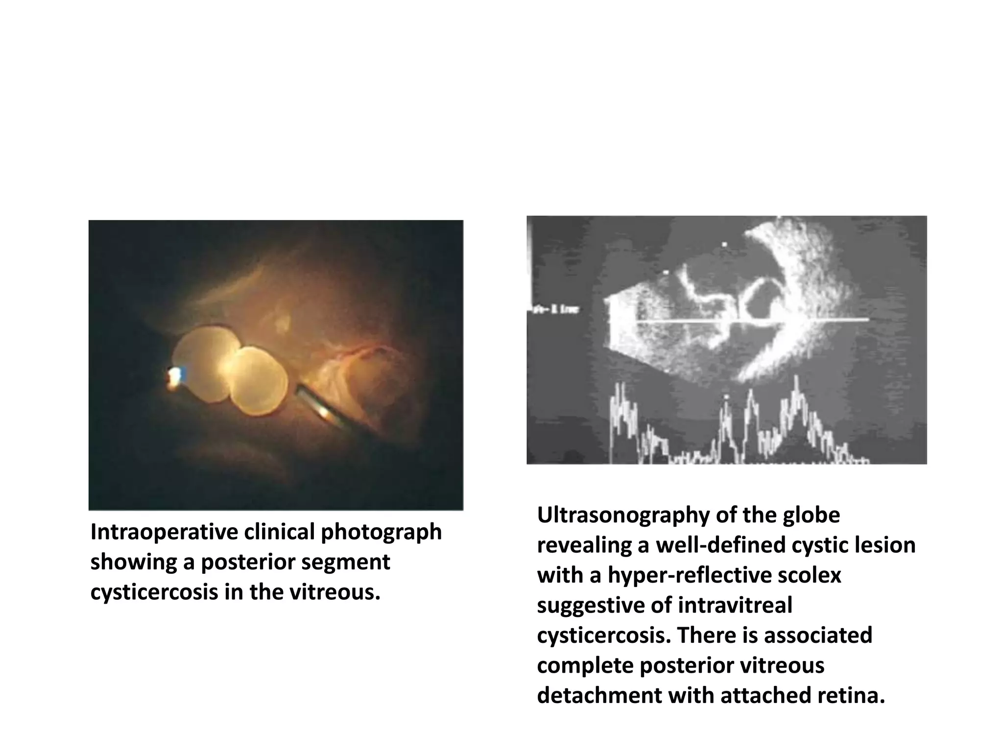 ocular cysticercosis | PPTX