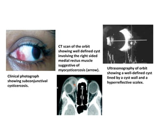ocular cysticercosis | PPTX