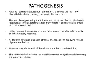ocular cysticercosis | PPTX