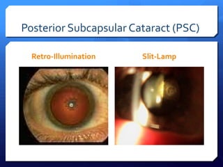 Selected Ocular Disorders & Procedures | PPT