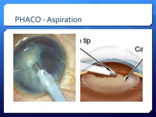 Selected Ocular Disorders & Procedures | PPT