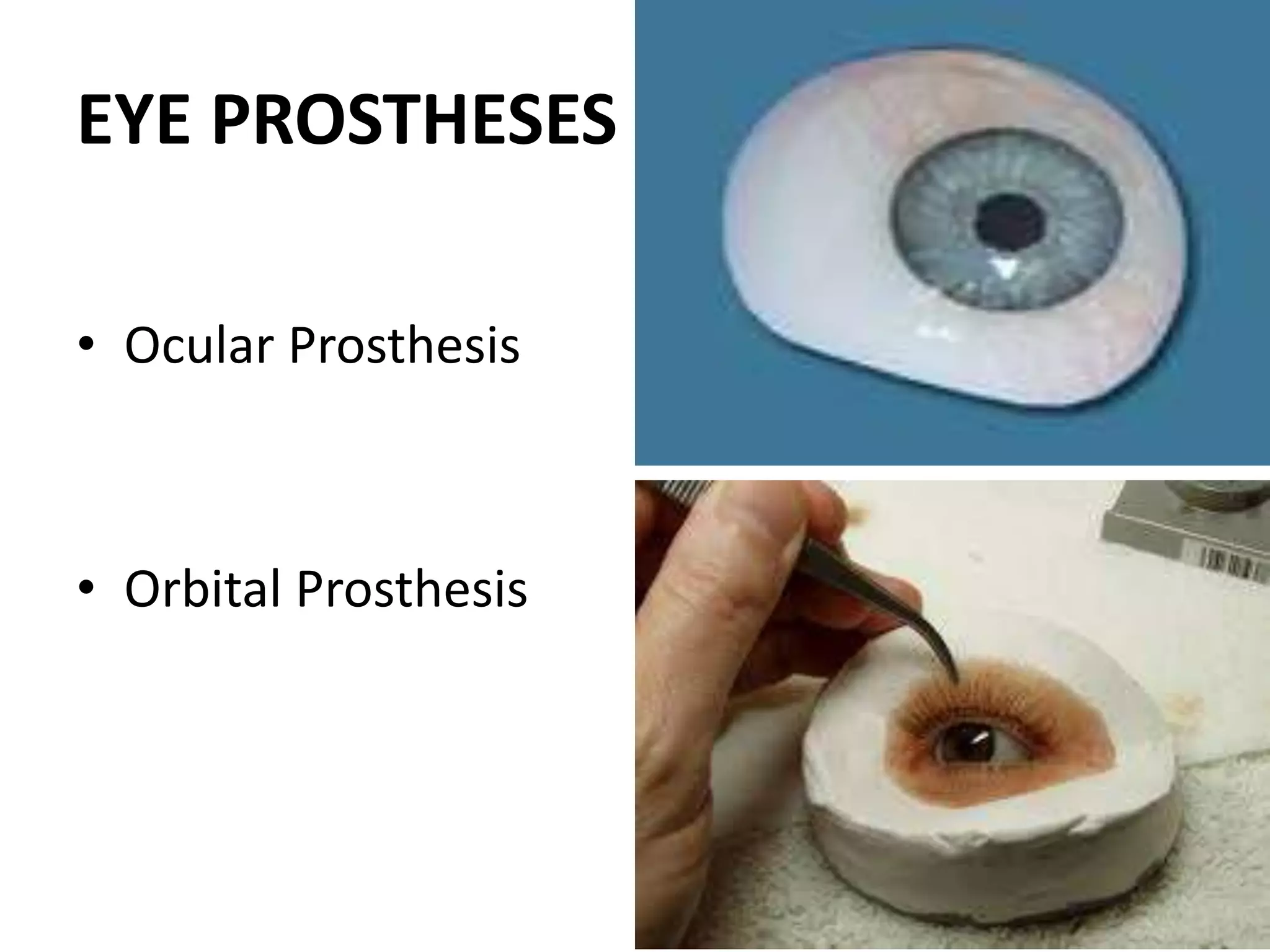 Ocular Prosthesis Fabrication | PPTX