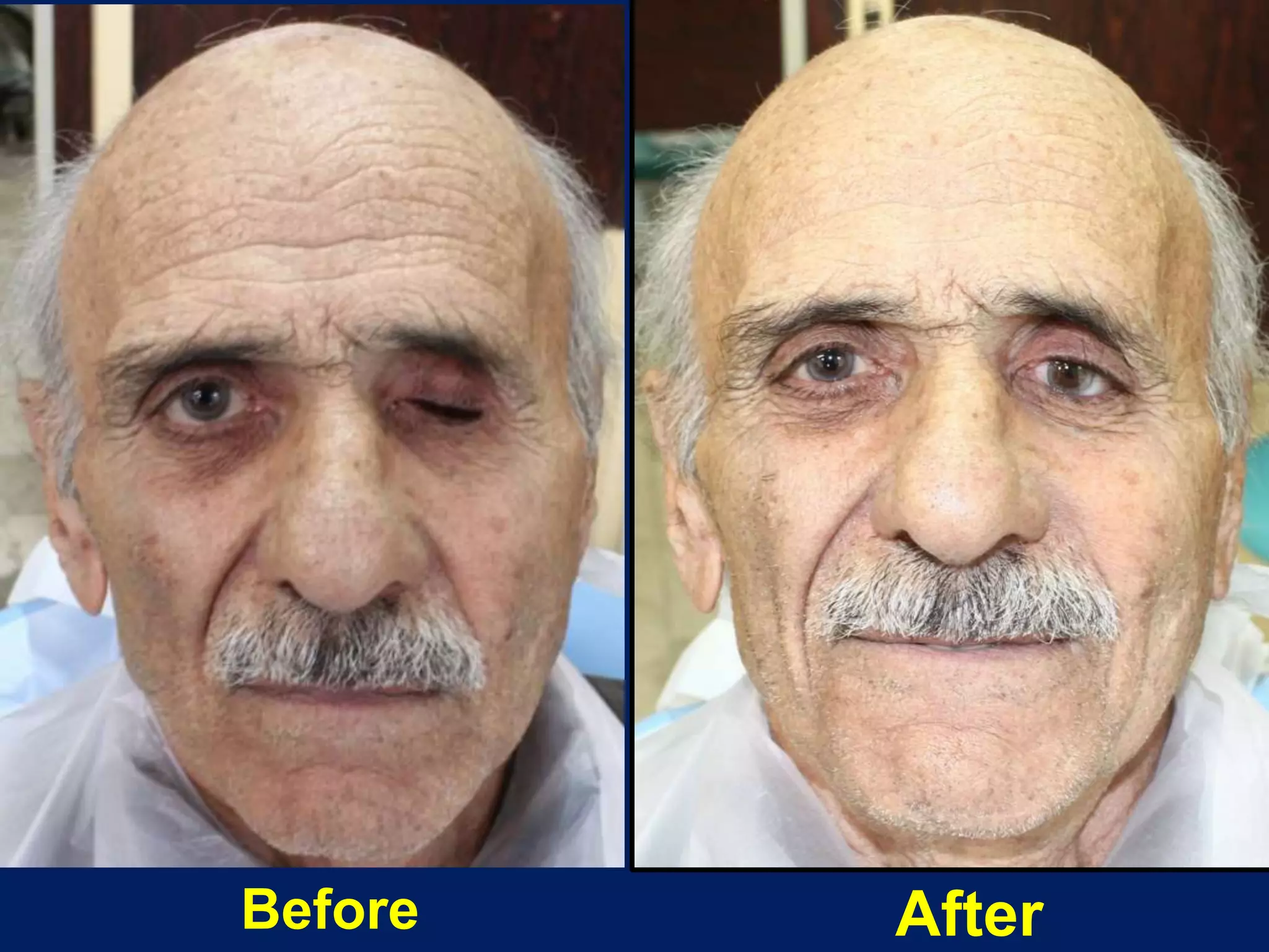 Ocular Prosthesis Fabrication | PPTX