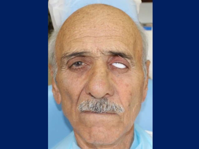Ocular Prosthesis Fabrication | PPTX | Eye and Vision Conditions ...