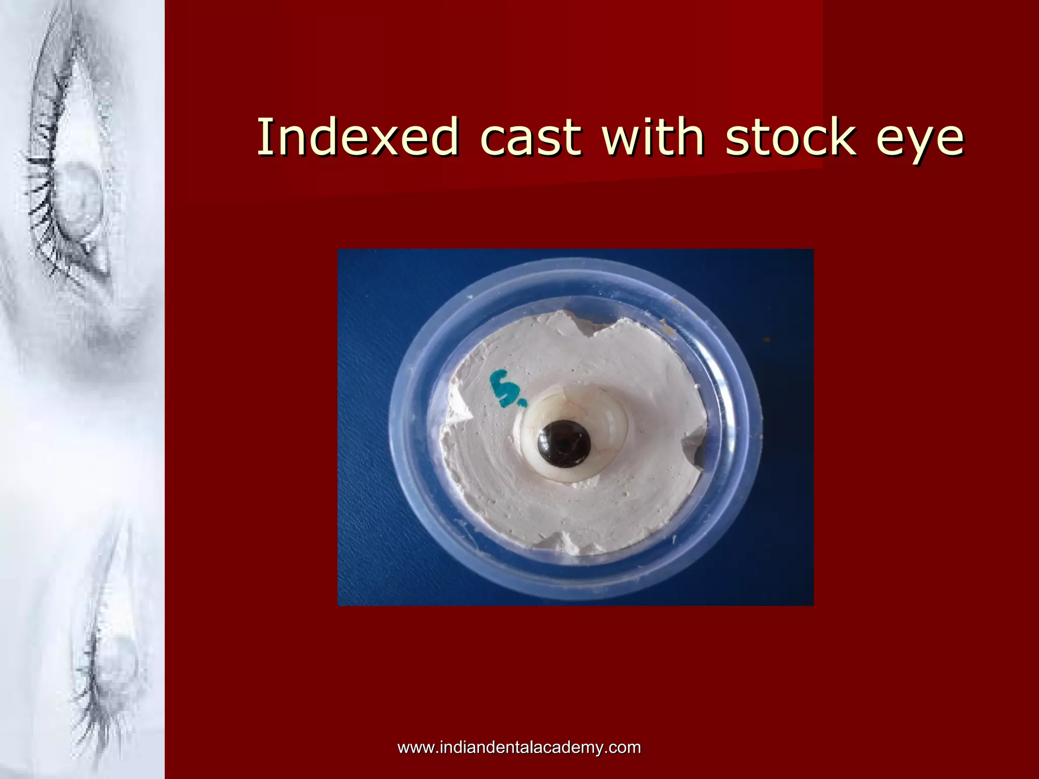 Ocular prosthesis final 3 | PPT