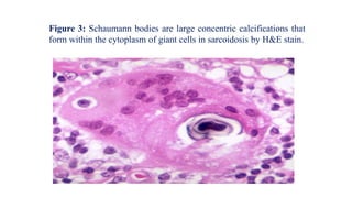 Ocular sarcoidosis | PPTX