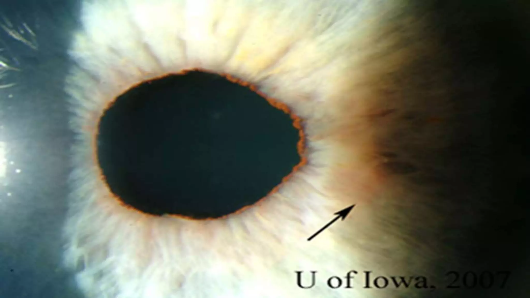 Ocular sarcoidosis | PPTX