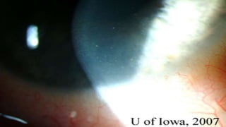 Ocular sarcoidosis | PPTX