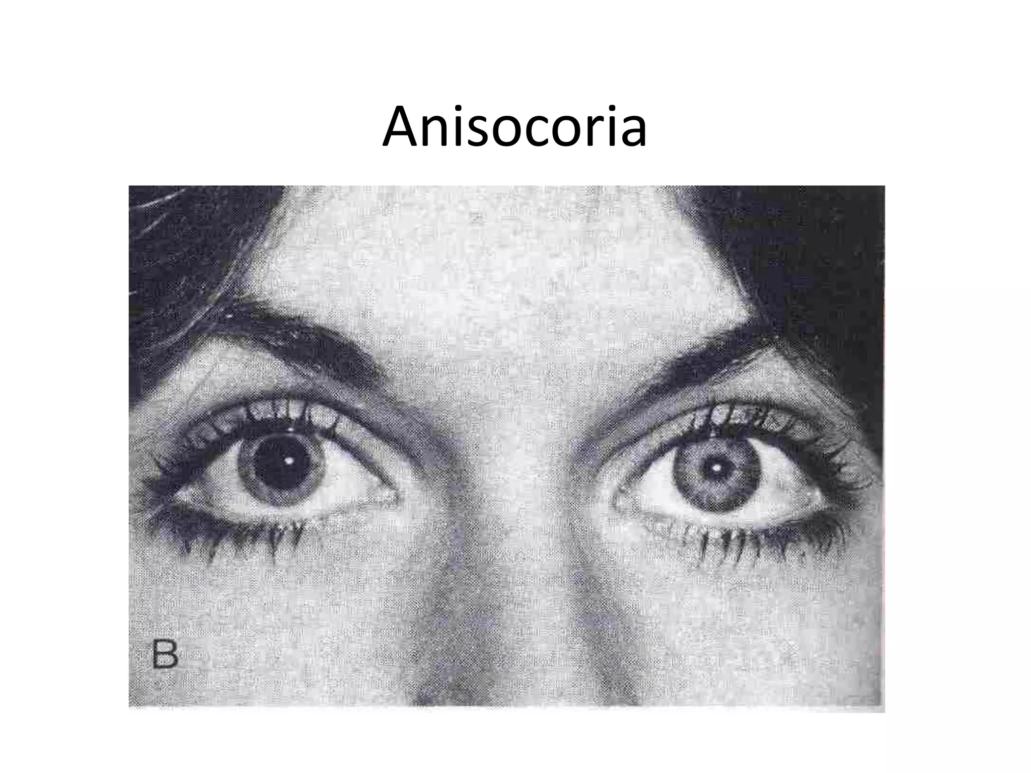 Ocular signs in medicine/ neurology | PPTX