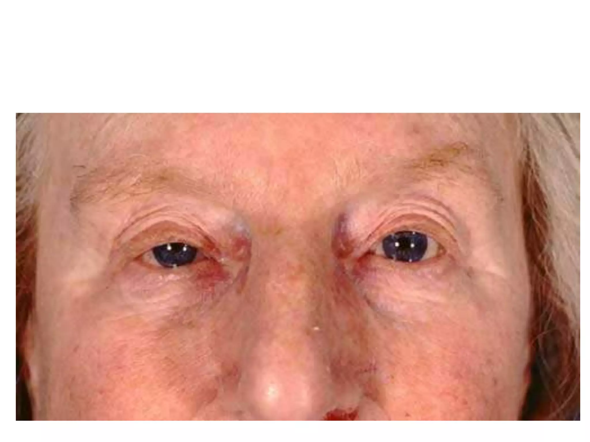 Ocular signs in medicine/ neurology | PPTX