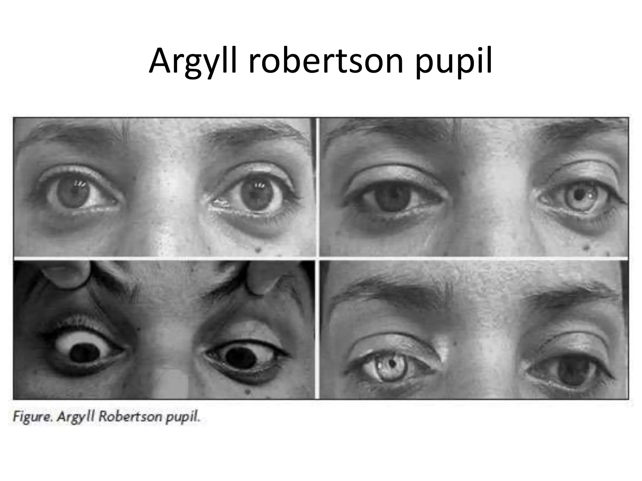Ocular signs in medicine/ neurology | PPTX