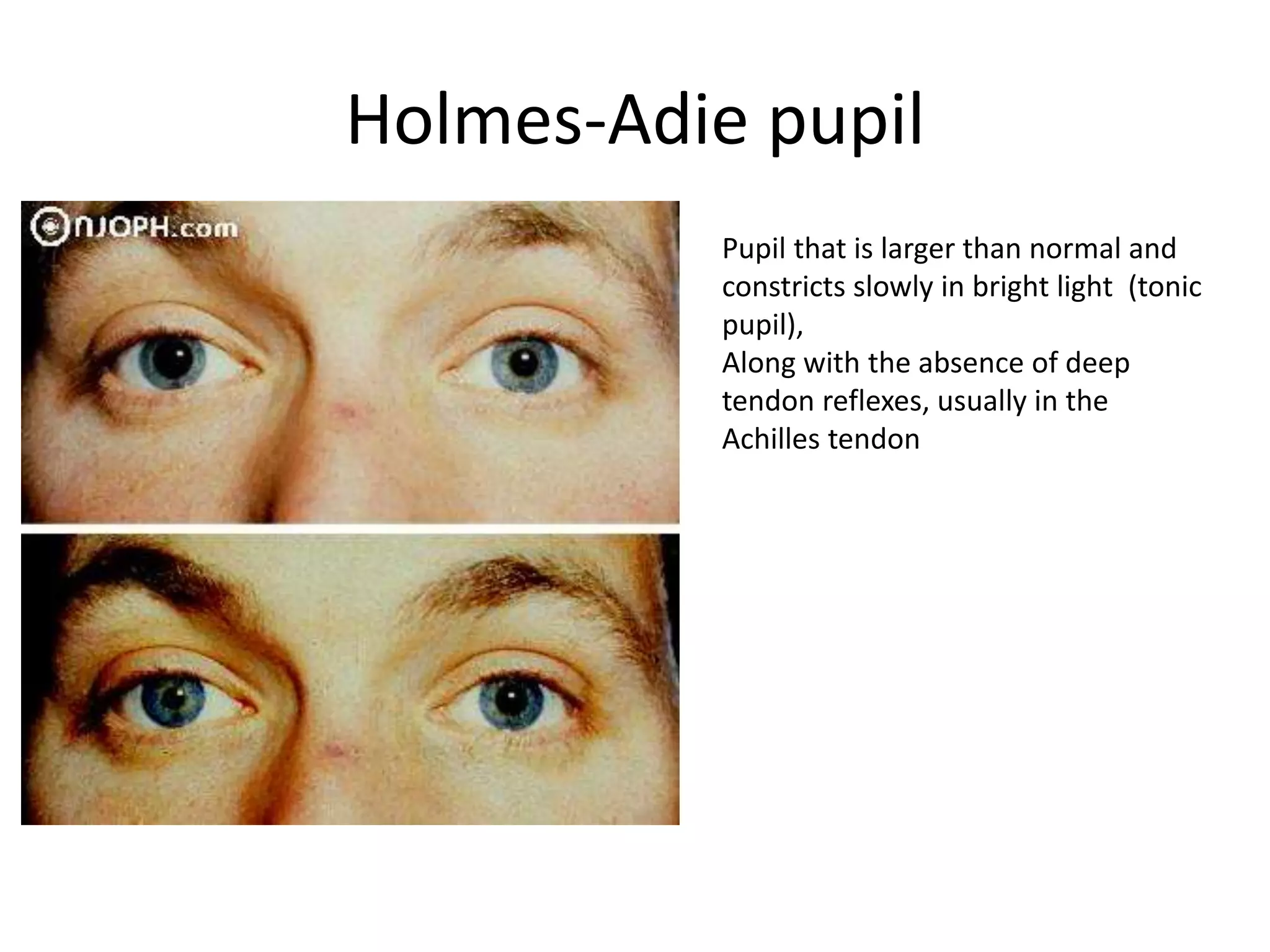 Ocular signs in medicine/ neurology | PPTX