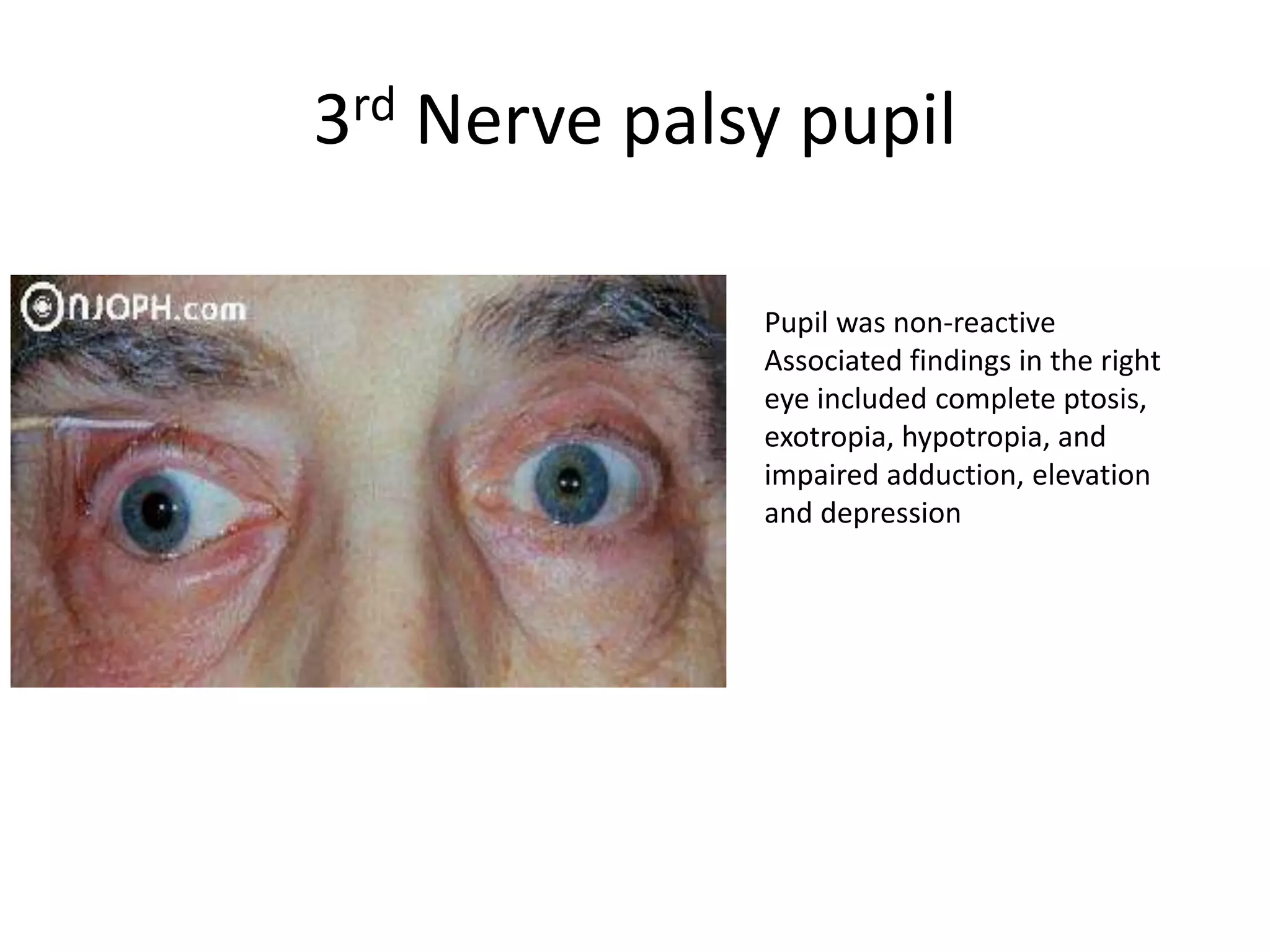 Ocular signs in medicine/ neurology | PPTX