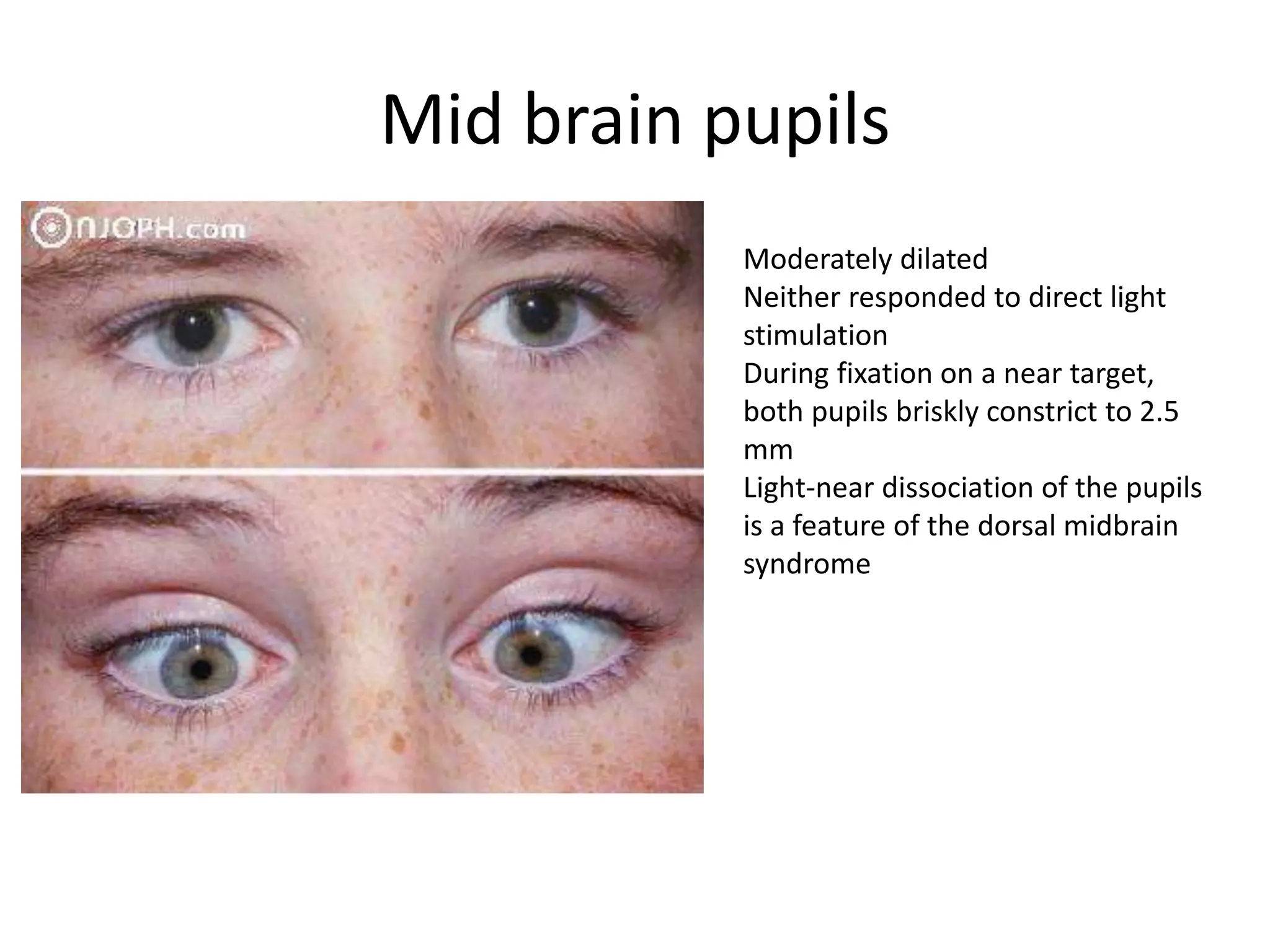 Ocular signs in medicine/ neurology | PPTX