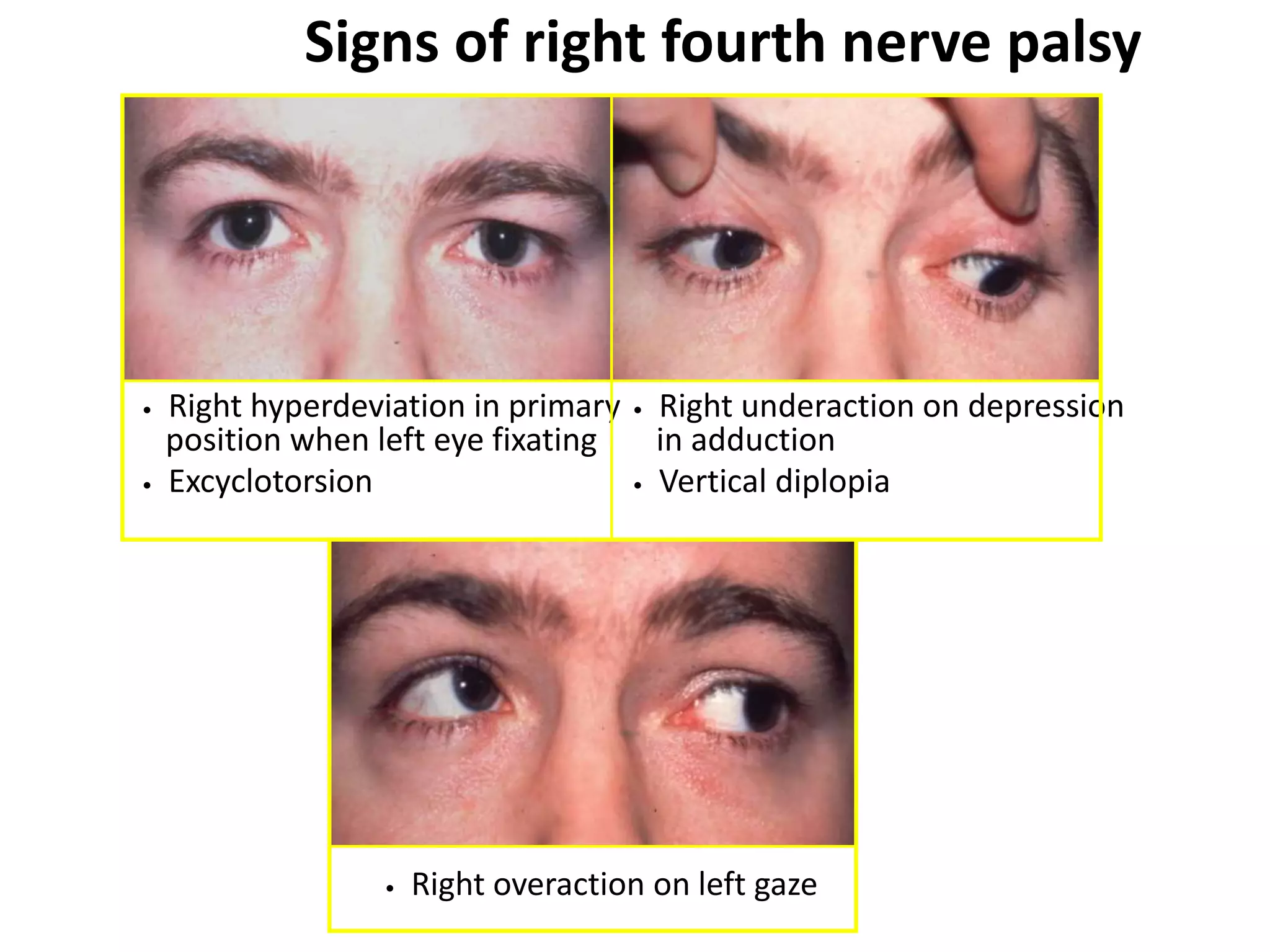 Ocular signs in medicine/ neurology | PPTX