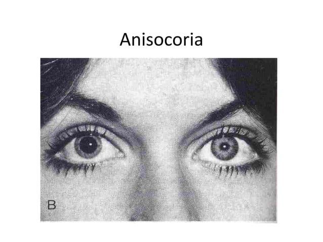 Ocular signs in medicine/ neurology | PPTX | Eye and Vision Conditions ...