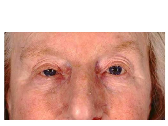 Ocular signs in medicine/ neurology | PPTX | Eye and Vision Conditions ...