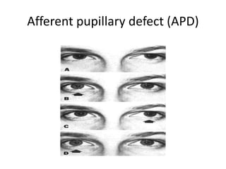 Ocular signs in medicine/ neurology | PPTX