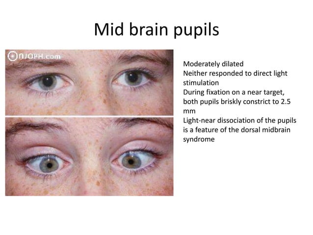 Ocular signs in medicine/ neurology | PPTX | Eye and Vision Conditions ...