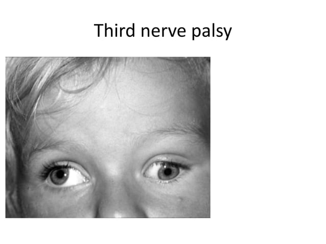 Ocular signs in medicine/ neurology | PPTX | Eye and Vision Conditions ...