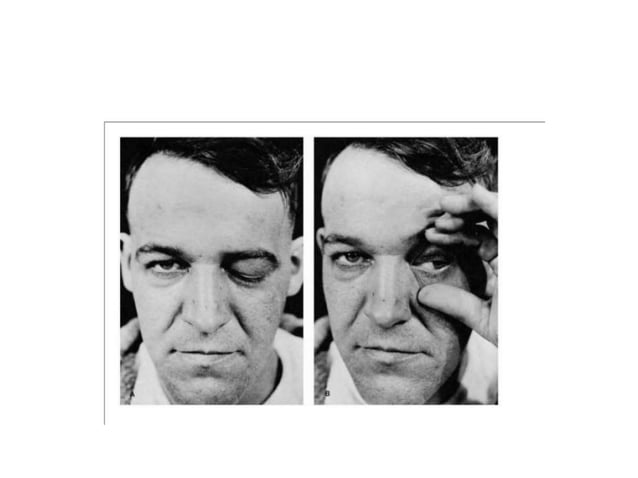 Ocular signs in medicine/ neurology | PPTX | Eye and Vision Conditions ...