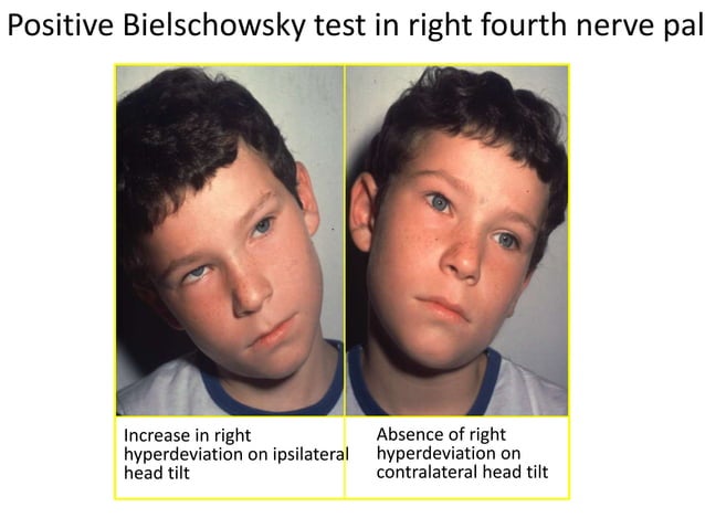 Ocular signs in medicine/ neurology | PPTX | Eye and Vision Conditions ...