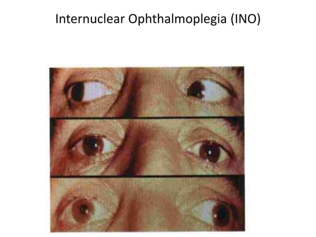 Ocular signs in medicine/ neurology | PPTX | Eye and Vision Conditions ...