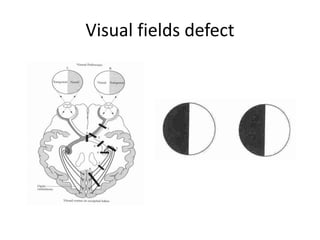 Ocular signs in medicine/ neurology | PPTX