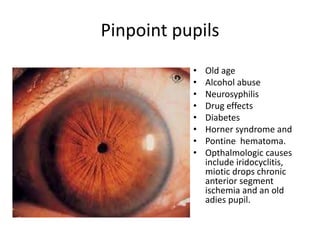 Ocular signs in medicine/ neurology | PPT
