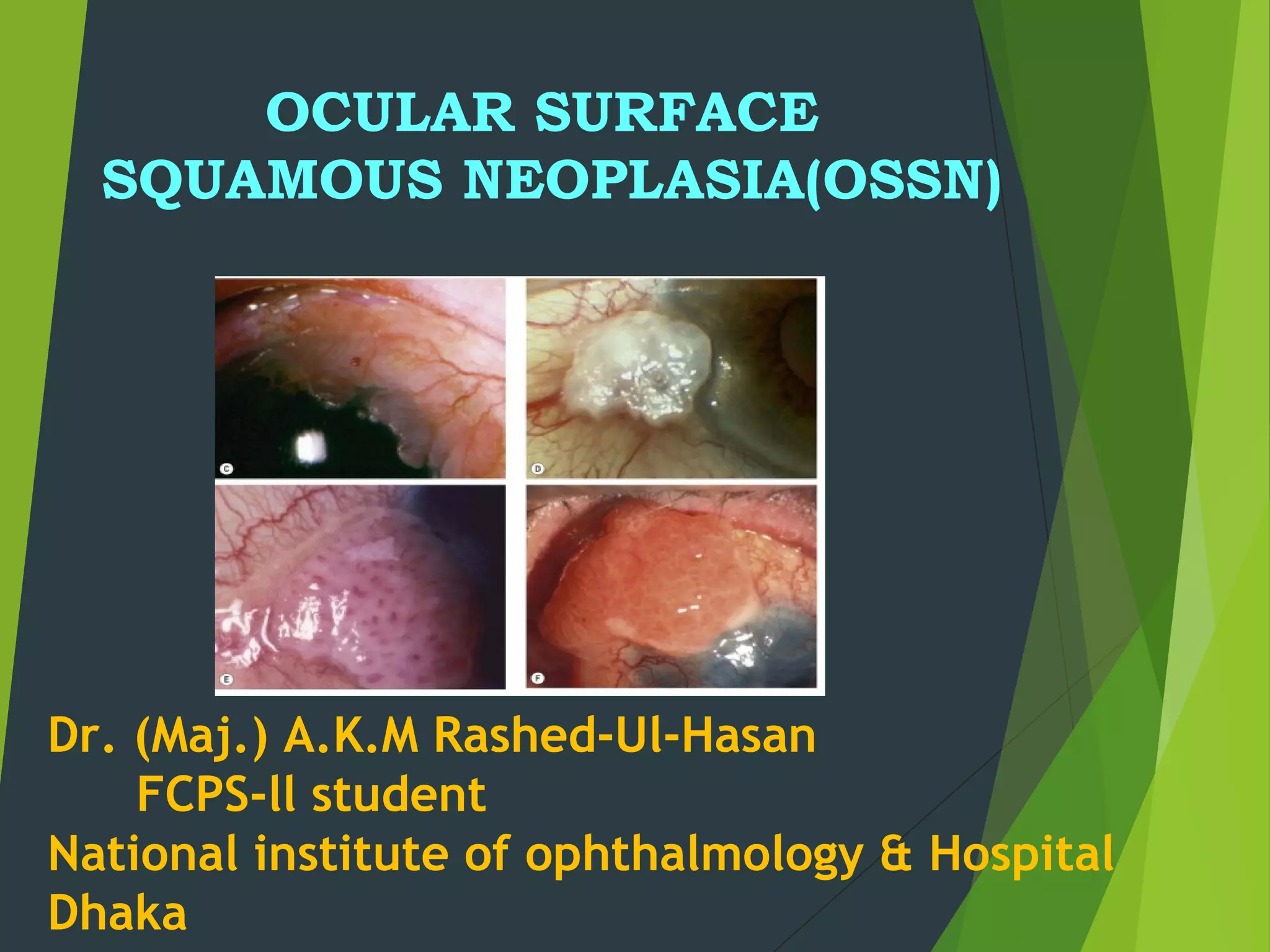 Ocular surface squamous neoplasia | PPT