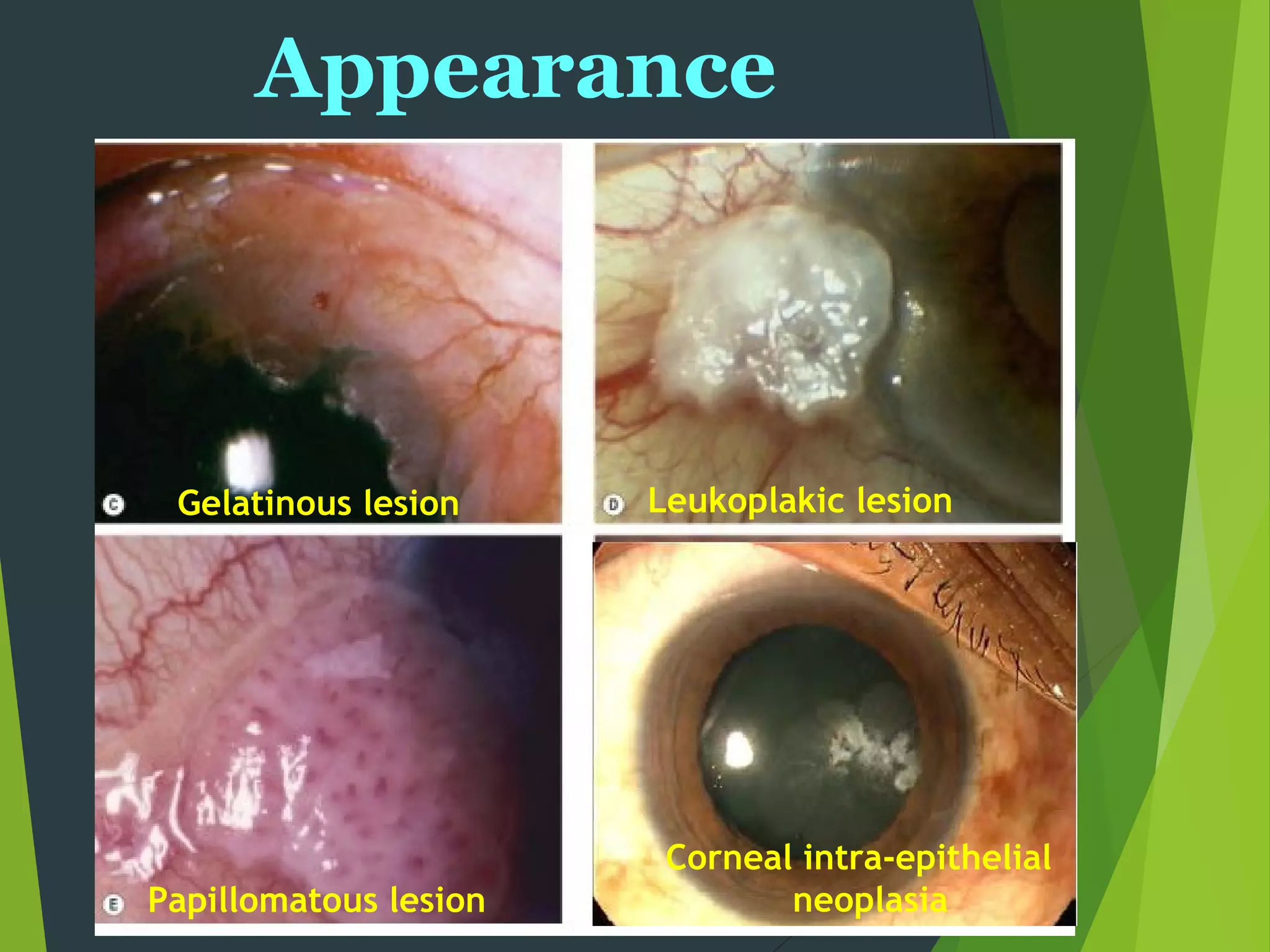 Ocular surface squamous neoplasia | PPT