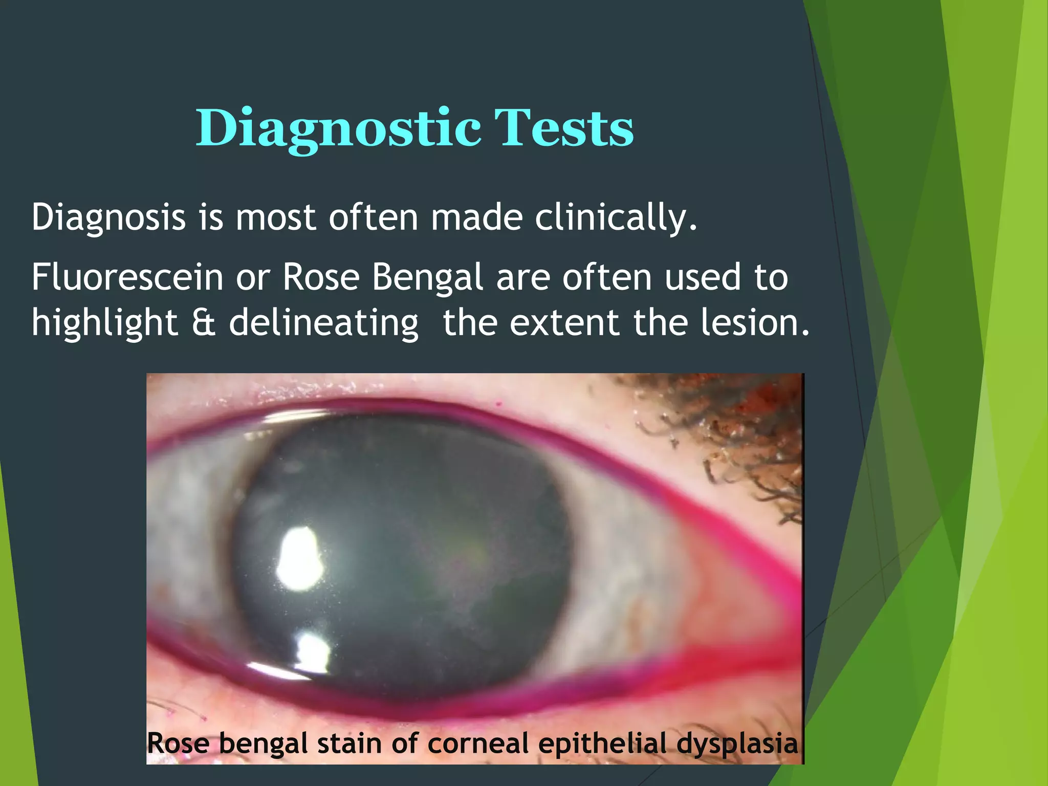 Ocular surface squamous neoplasia | PPT