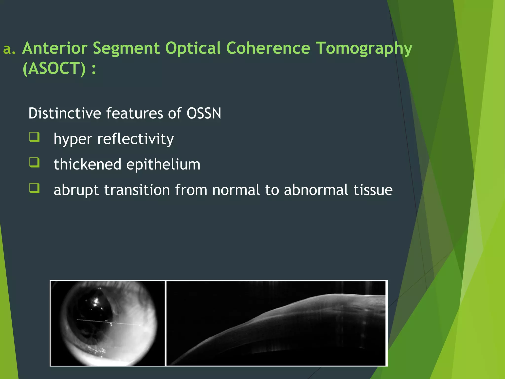 Ocular surface squamous neoplasia | PPT