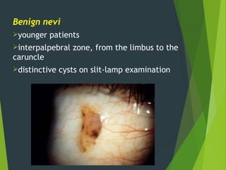 Ocular surface squamous neoplasia | PPT