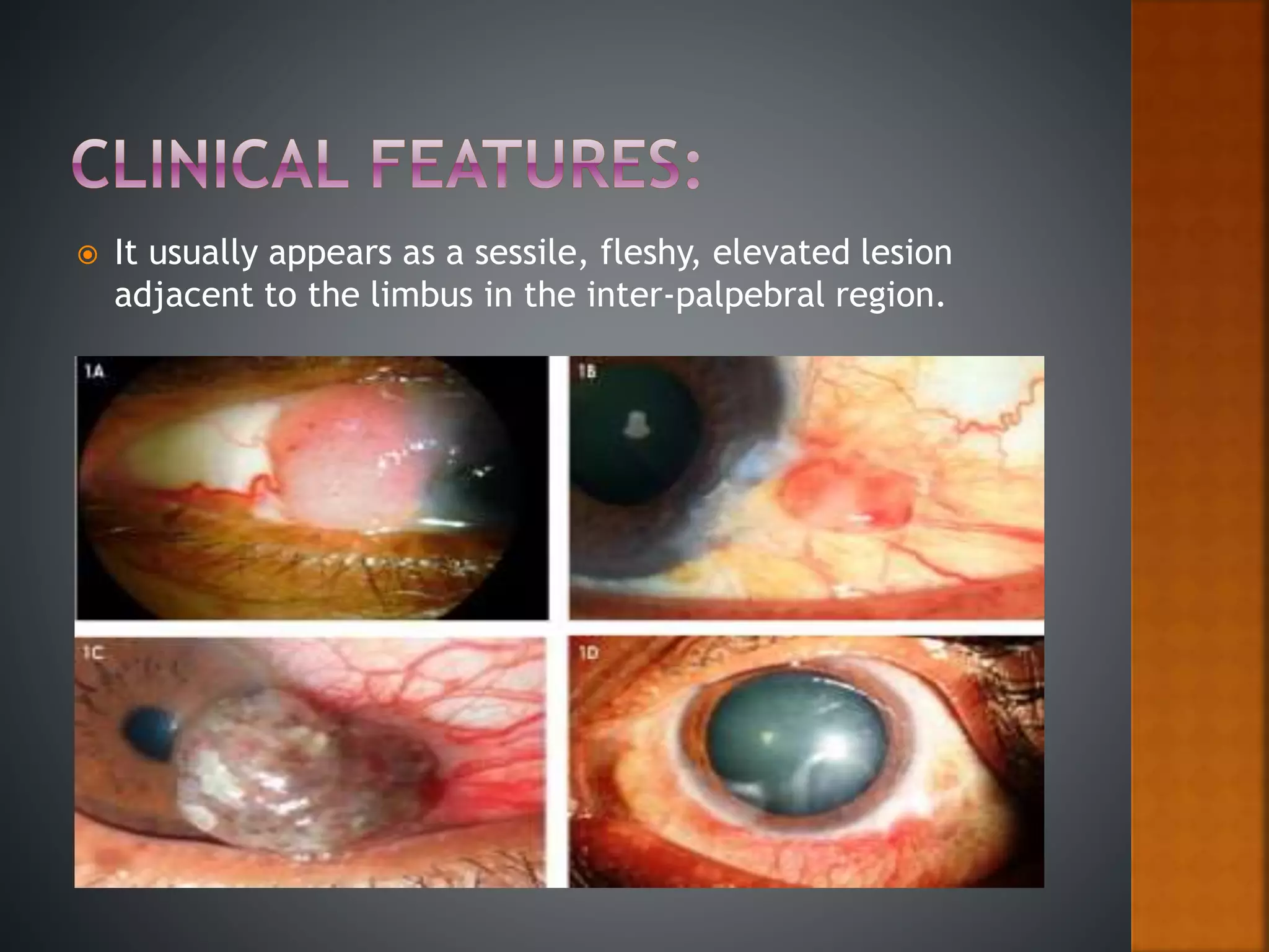 Ocular surface squamous neoplasia | PPTX