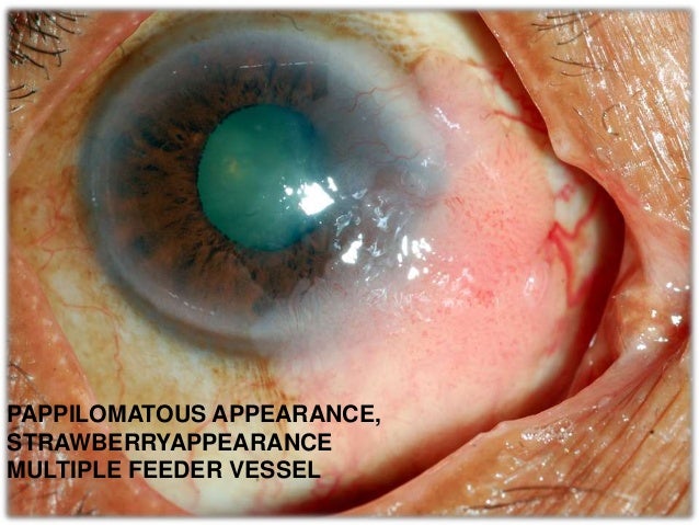 Ocular surface squamous neoplasiaa.ppt1