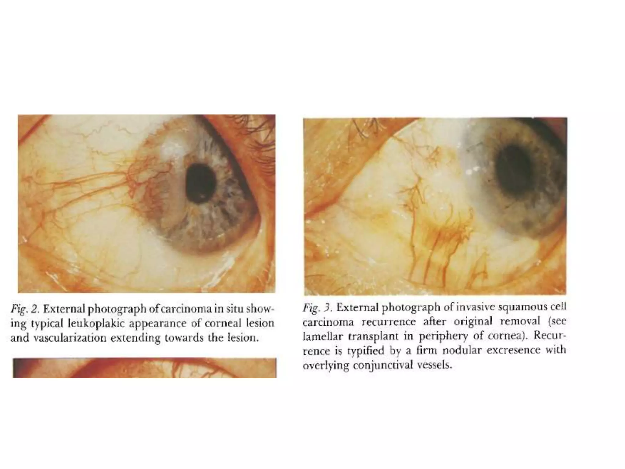Ocular surface squamous neoplasia(ossn) | PPTX