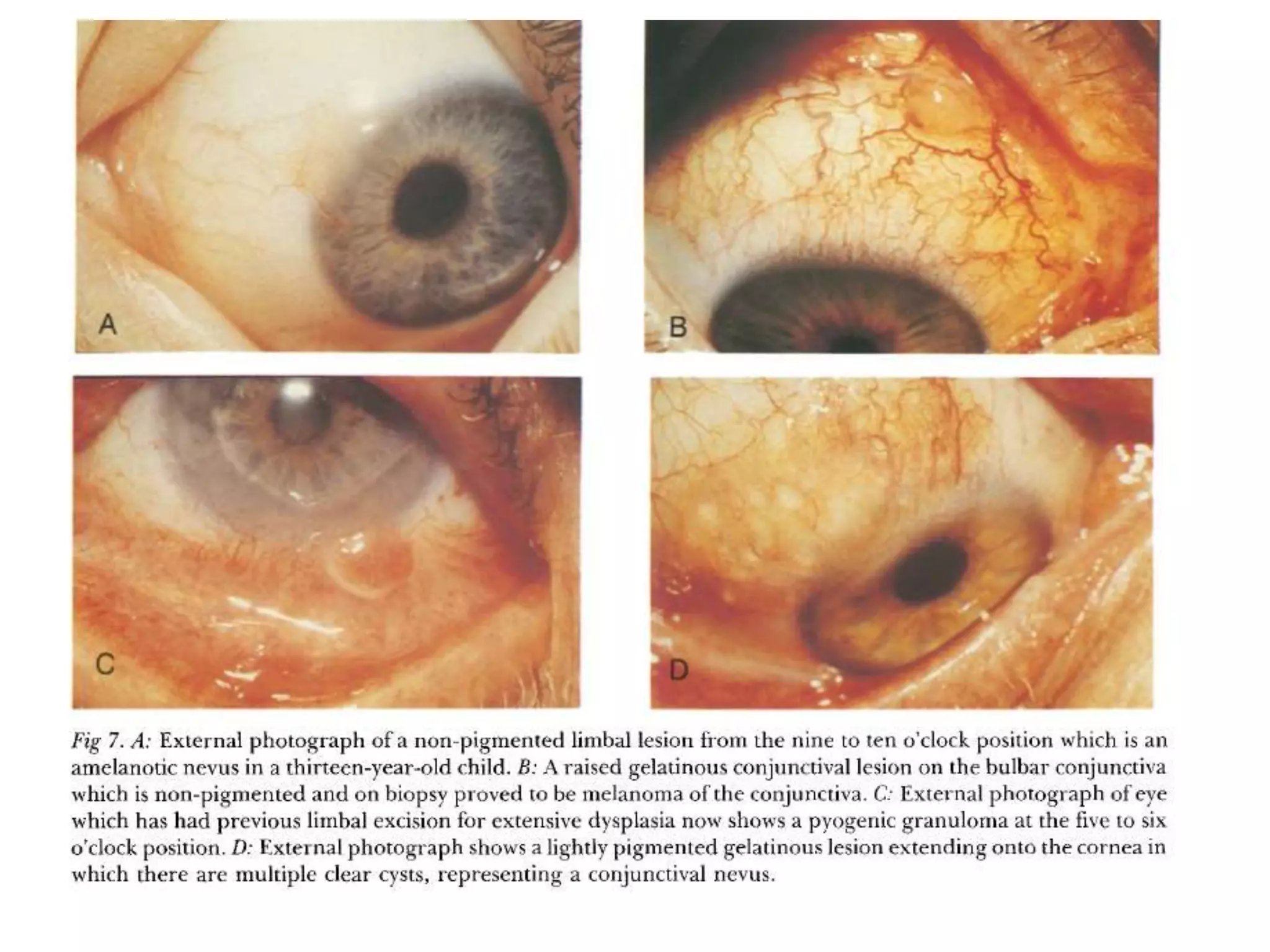 Ocular surface squamous neoplasia(ossn) | PPTX