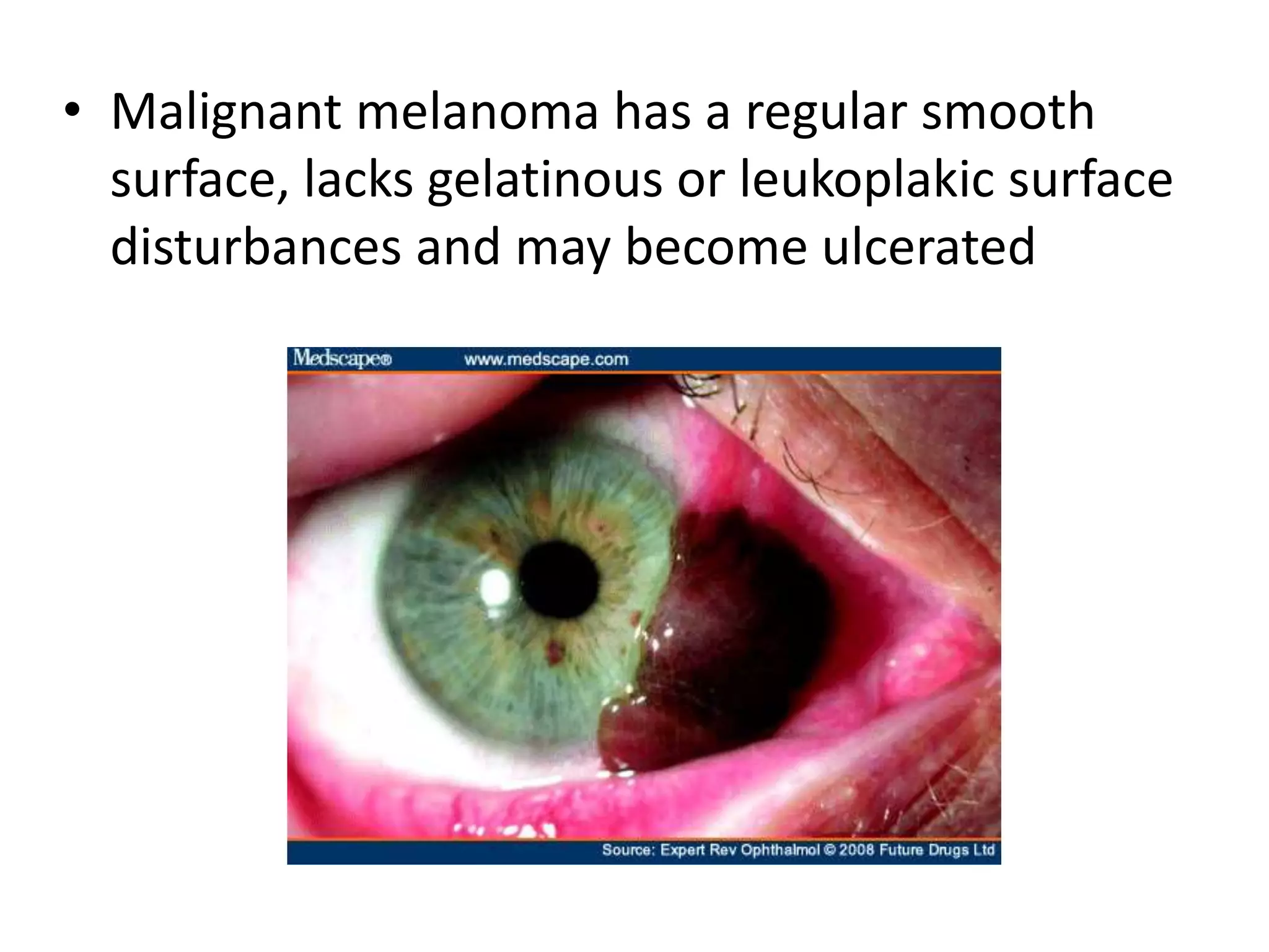 Ocular surface squamous neoplasia(ossn) | PPTX