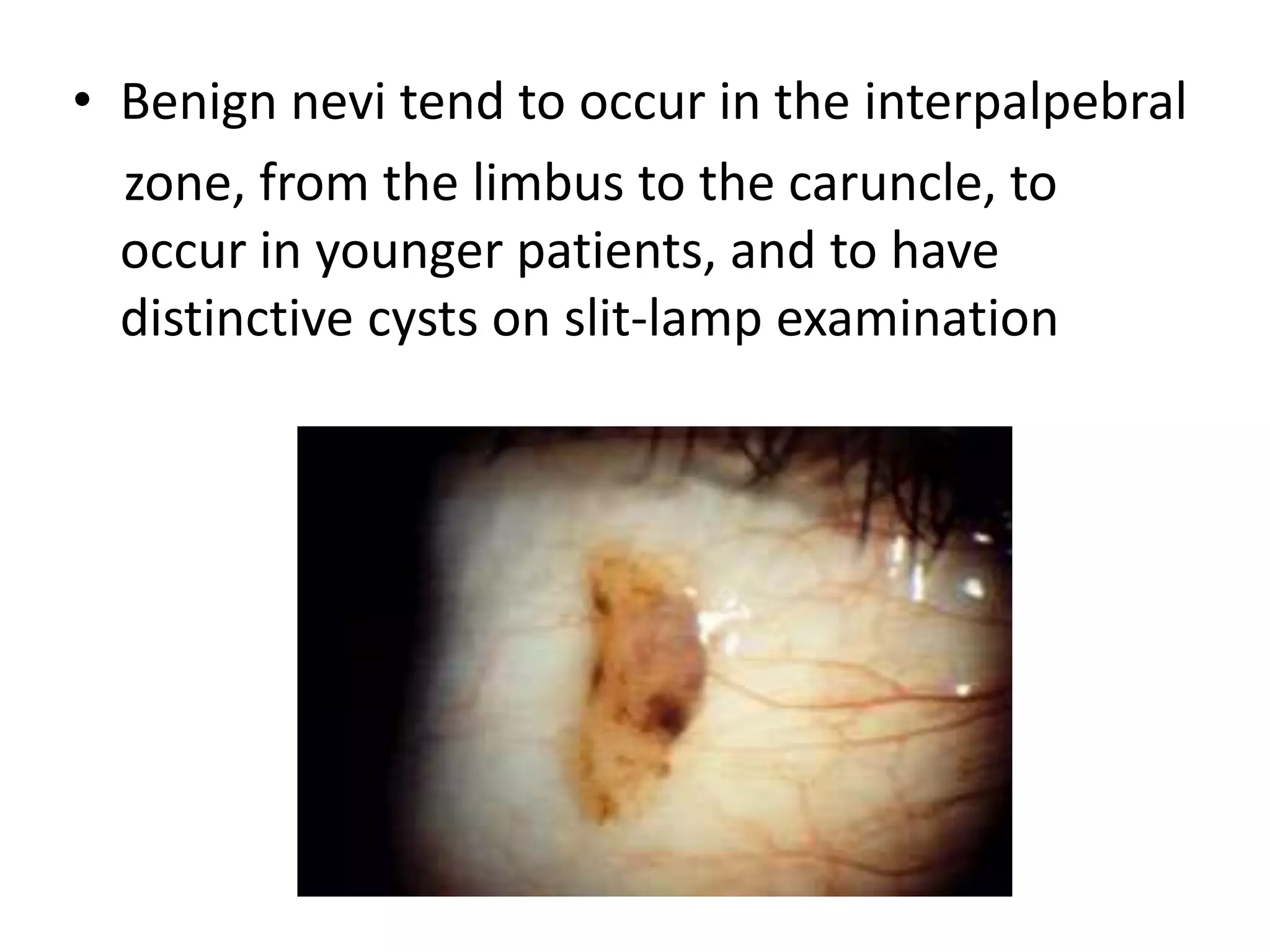 Ocular surface squamous neoplasia(ossn) | PPTX