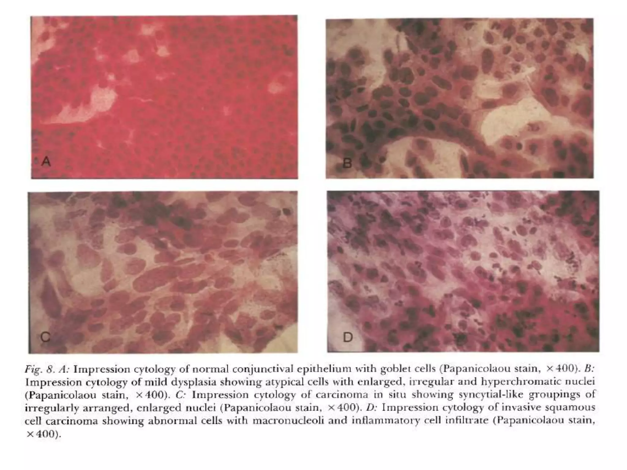 Ocular surface squamous neoplasia(ossn) | PPTX