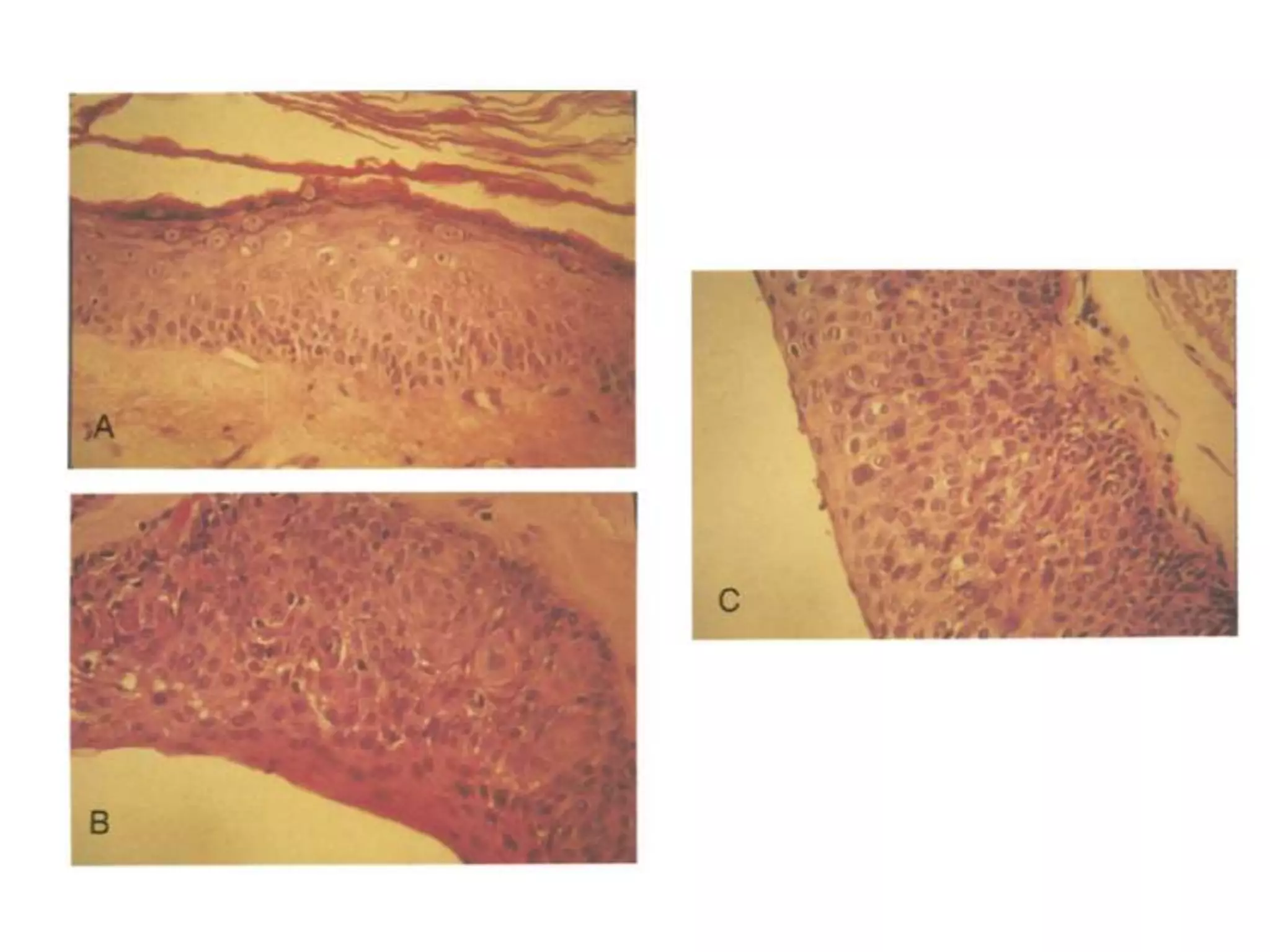 Ocular surface squamous neoplasia(ossn) | PPTX